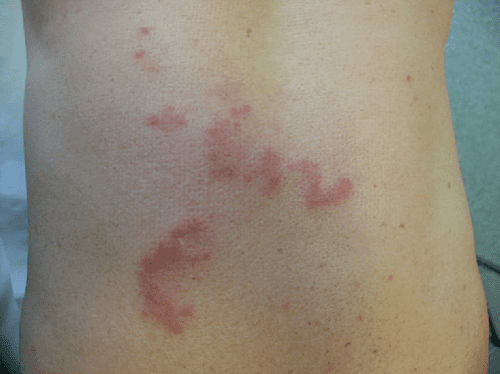 Could Jessner’s Lymphocytic Infiltrate of the Skin Be a Dermal Variant ...