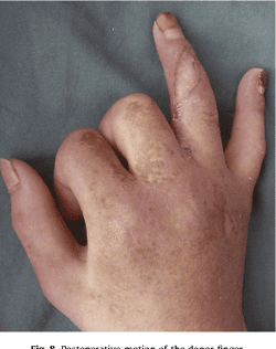 Figure 11 from Reconstruction of a soft tissue defect in the finger ...