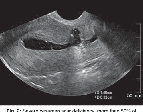 Various Types of Niche Imaging by Sonohysterography: A Pictorial Review ...