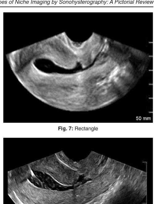 Various Types of Niche Imaging by Sonohysterography: A Pictorial Review ...