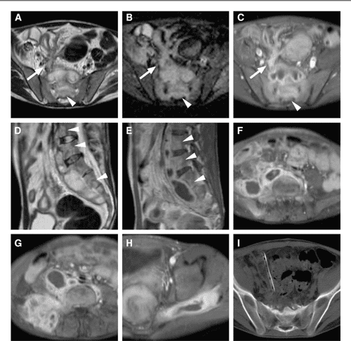 Figure 1 from Comprehensive MRI diagnosis of sacral osteomyelitis and ...