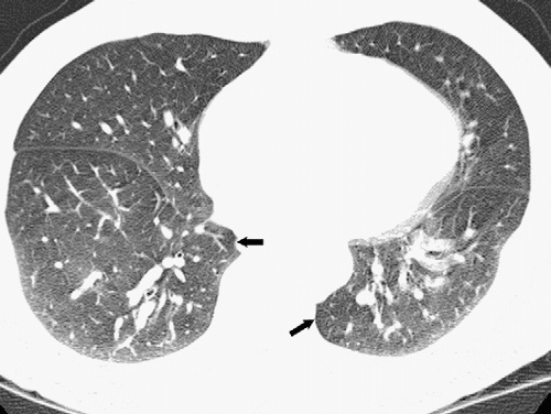Table 1 from Imaging of small airways disease and chronic obstructive ...