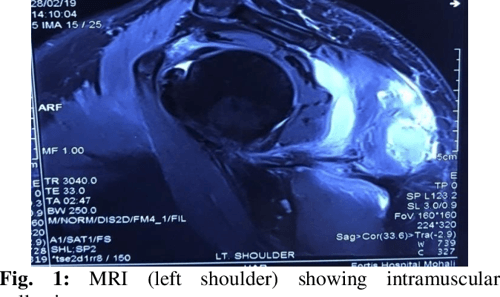 A case report of shoulder abscess secondary to attempted intraarticular ...