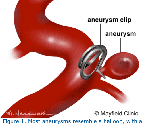Figure 4 from Aneurysm clipping. | Semantic Scholar