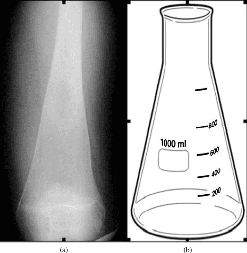 Figure 2 from Quantifying the Erlenmeyer flask deformity. | Semantic ...