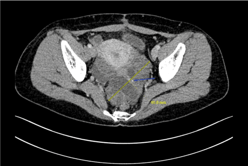 Figure 2 from Growing Teratoma Syndrome with Synchronous Gliomatosis ...