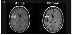 Figure 1 from The anatomy of spatial neglect | Semantic Scholar