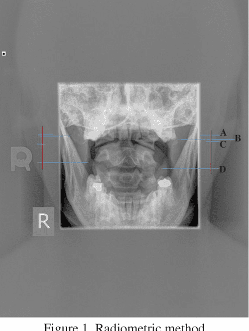 Figure 1 from Validity of palpation of the C1 transverse process ...