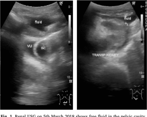 Successful Boari Flap ureteroneocystostomy for distal ureteral necrosis ...