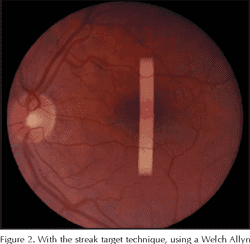 Figure 4 from Comparison of eccentric fixation measurements using the ...