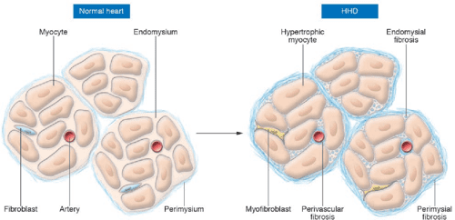 Figure 1 from ECM remodeling in hypertensive heart disease. | Semantic ...