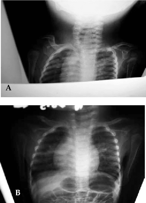 Figure 2 from Trisomy 8 Mosaicism in Two Filipino Children | Semantic ...
