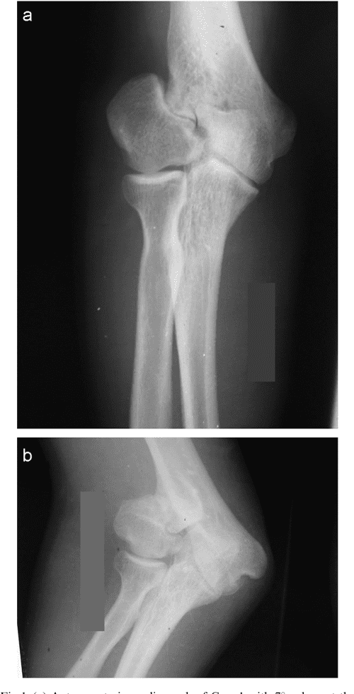 Table 5 from Severe Tardy Ulnar Nerve Palsy caused by Traumatic Cubitus ...