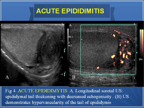 Figure 6 From Sonographic Findings Of Epididymal Masses Semantic Scholar