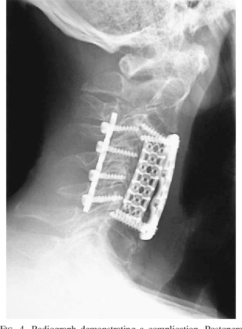 Figure 4 from Titanium cage reconstruction after cervical corpectomy ...