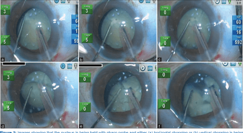 Capsular tension ring assisted phacoemulsification of morgagnian ...