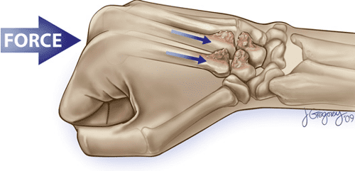 [PDF] Disabling hand injuries in boxing: boxer's knuckle and traumatic ...