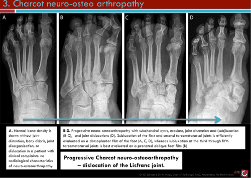 Charcot foot and Osteomyelitis in diabetes – Radiologist: Friend or Foe ...