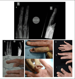 Figure 1 from Osteomyelitis of the hand | Semantic Scholar