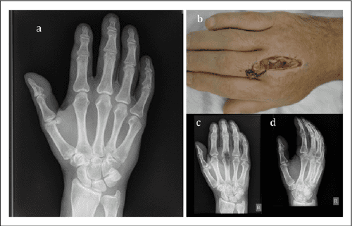 Figure 1 from Osteomyelitis of the hand | Semantic Scholar