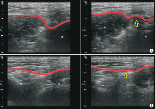Figure 3 from Diagnosis of Groin Pain Associated With Sports Hernia ...