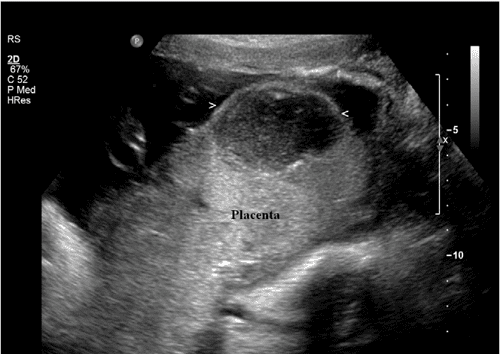 Figure 7 from Ultrasound of the placenta: a systematic approach. Part I ...