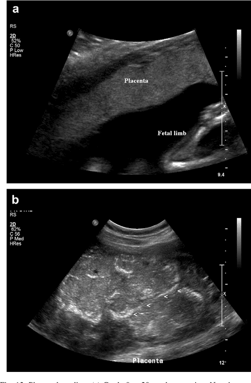 Figure 4 from Ultrasound of the placenta: a systematic approach. Part I ...
