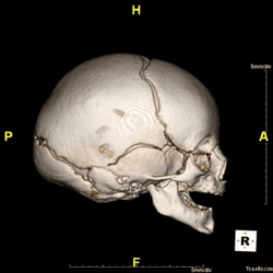 Figure 1 from Bathrocephaly: a case report of a head shape associated ...