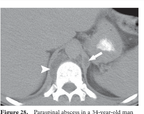 The diaphragmatic crura and retrocrural space: normal imaging ...