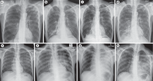 Table 1 from Autologous Blood Patch Pleurodesis for the Management of a ...