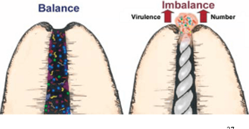 Figure 1 from Endodontic Flare Ups – An Overview | Semantic Scholar