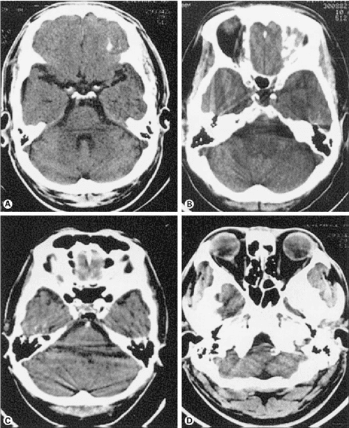 Clinical Implication Of Cerebral Artery Calcification On Brain Ct
