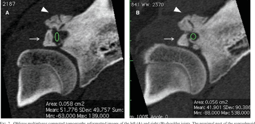 Imaging diagnosis-bilateral abnormal ossification of the supraglenoid ...
