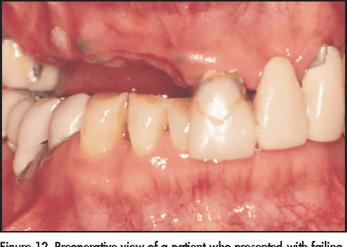 [PDF] The interproximal height of bone: a guidepost to predictable ...