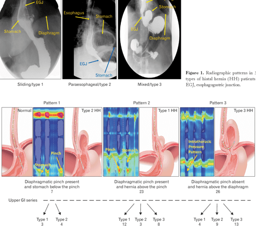 [PDF] Morphology of the Esophageal Hiatus: Is It Different in 3 Types ...
