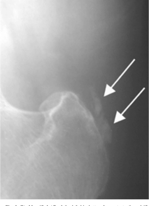 Figure 2 from Hydroxyapatite Deposition Disease Radiology Corner ...