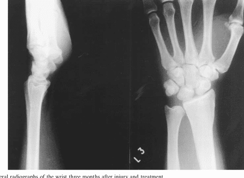 Dorsal Dislocation of the Capitate | Semantic Scholar