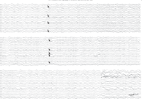 Figure 2 from EEG extreme delta brush: An ictal pattern in patients ...
