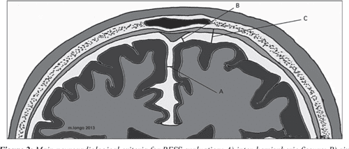 [PDF] Benign Enlargement of Subarachnoid Space in Infancy: "A Review ...