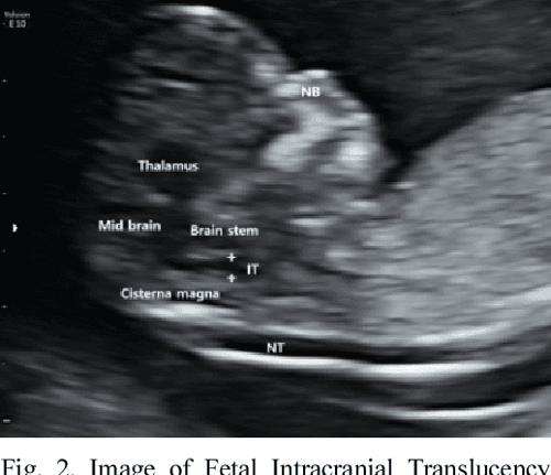 Table 1 from Design of Standard Value Intracranial Translucency of ...