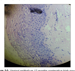 Figure 3 from New laparoscopic peritoneal pull-through vaginoplasty ...