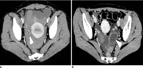Figure 3 from Ruptured Corpus Luteal Cyst: Prediction of Clinical ...