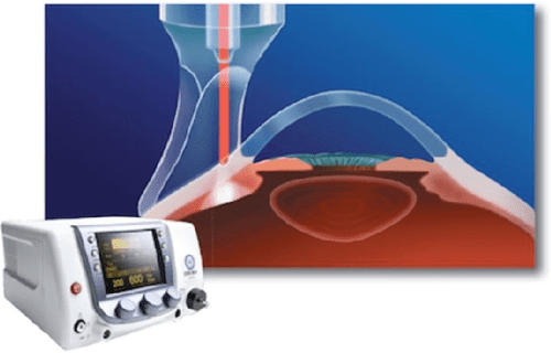 [PDF] IRIDEX MicroPulse P3: innovative cyclophotocoagulation | Semantic ...