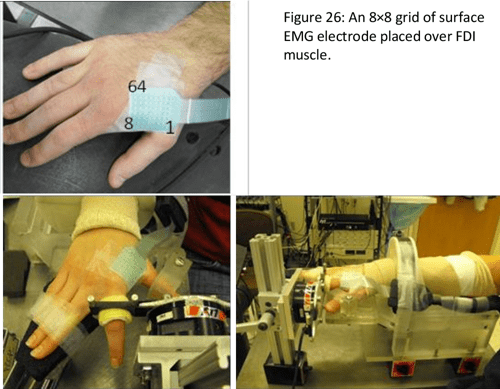 Figure 3 from Surface EMG Examination of Amyotrophic Lateral Sclerosis ...