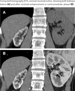 Figure 1 from Cortical nephrocalcinosis asymmetrically involving the ...