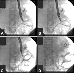 Figure 1 from Management of afferent limb obstruction by use of EUS ...