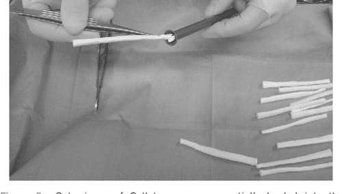 Intramedullary delivery of Collatamp in long bone infections: a simple ...