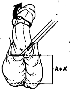 Figure 8 from A technique for foreskin reconstruction and some ...