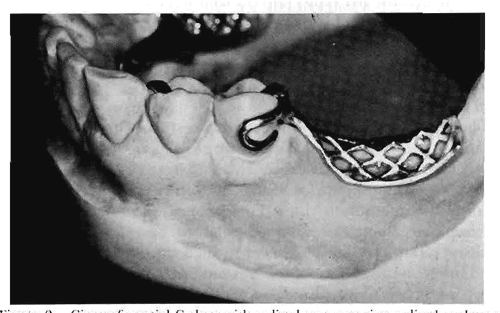 Figure 2 from RPI (rest, proximal plate, I bar) clasp retainer and its ...