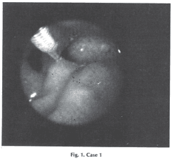 The acquired double pylorus. | Semantic Scholar